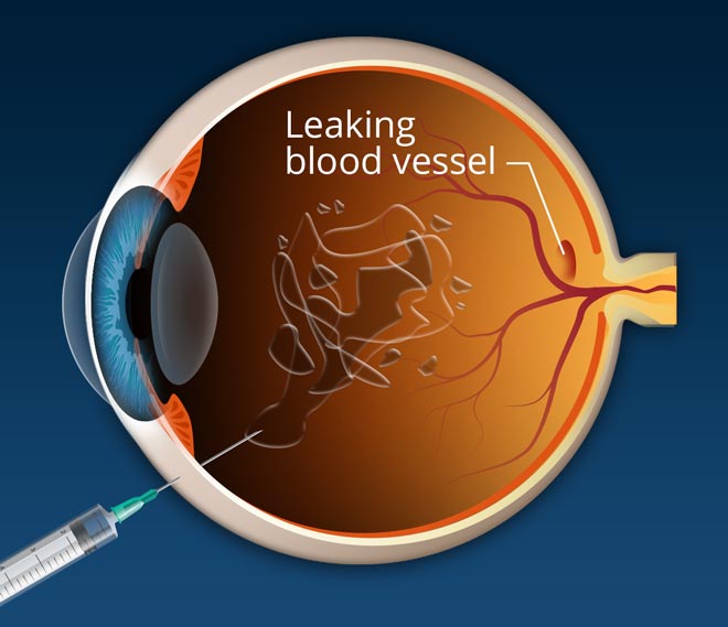 7 Treatments For Macular Degeneration or AMD 